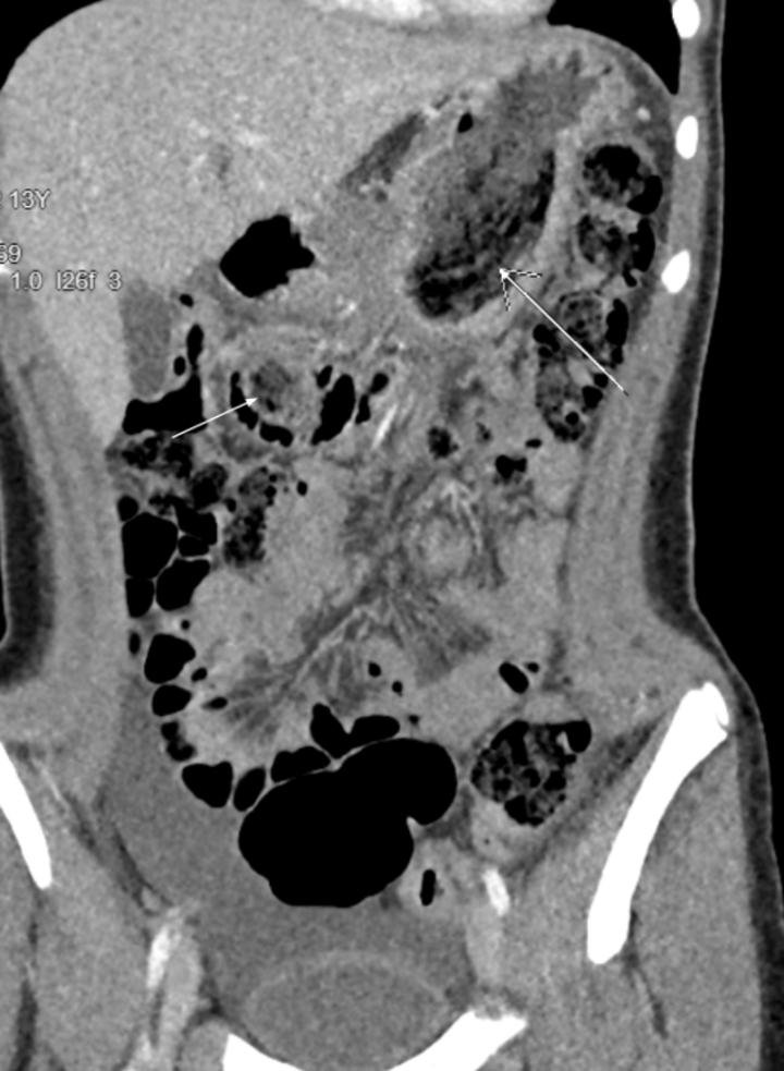 Teenager has two giant hairballs surgically removed from stomach and ...