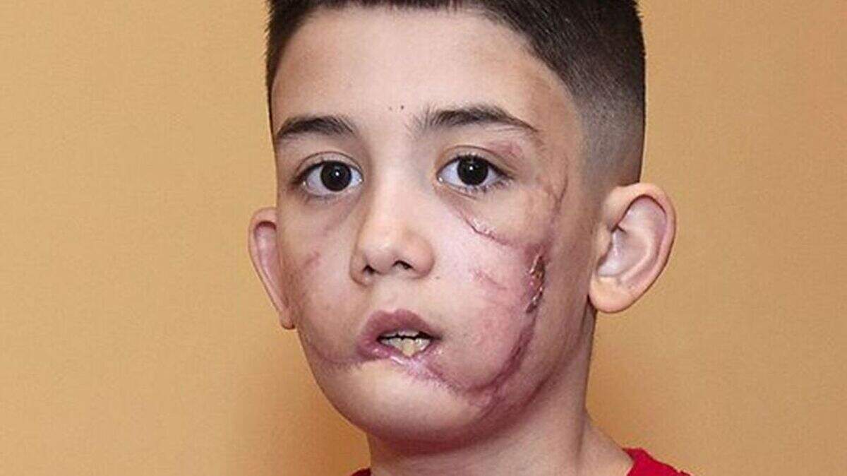 Alejandro Mizsan XL Bully attack: Young boy sues dog’s owners and ...