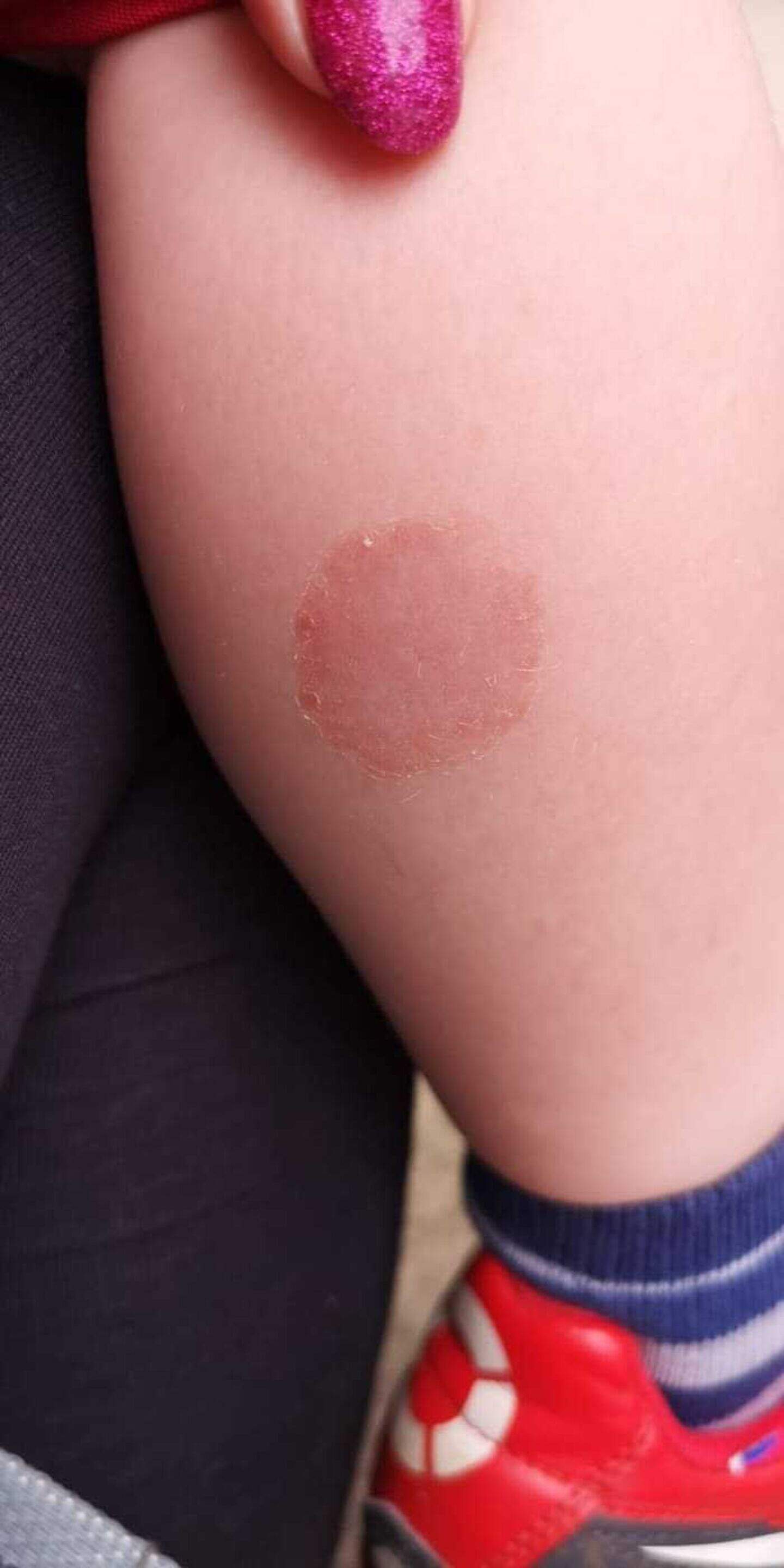 Spider experts warn of False Widow's venom bites after Waterford woman ...