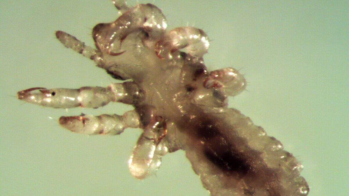 Stay Well: My kids keep getting lice. How can I get rid of them – for ...